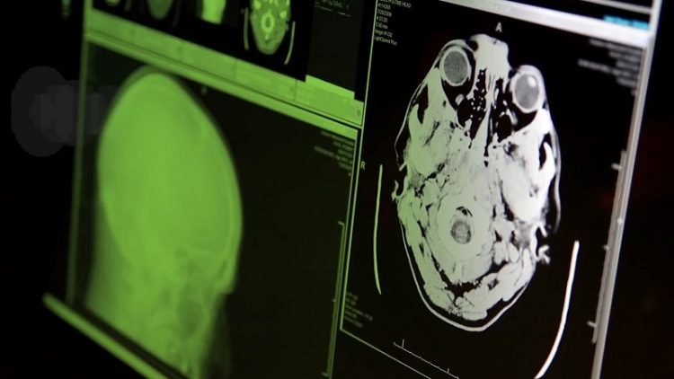 IBM Watson Health can now detect head trauma